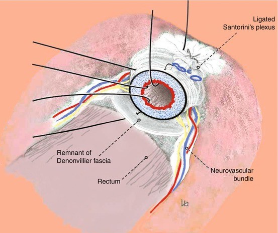 Ileal Orthotopic Bladder Substitute with an Afferent Isoperistaltic ...