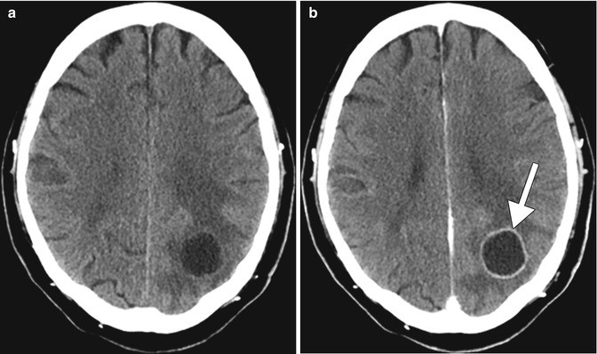 Iodinated Contrast Agents | SpringerLink