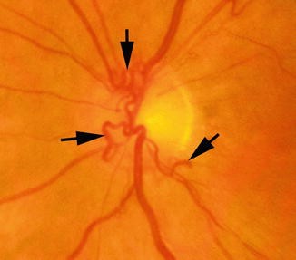 Blood Supply of the Optic Nerve Head | SpringerLink