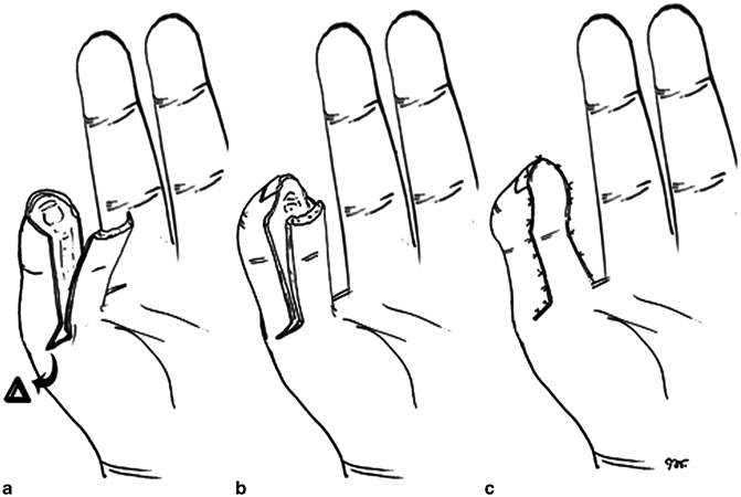 Reconstruction of the Thumb Tip | SpringerLink