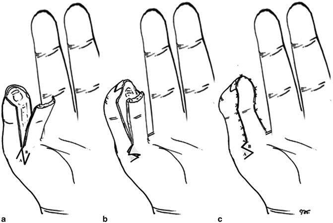 Reconstruction of the Thumb Tip | SpringerLink