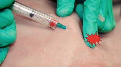 Injections | SpringerLink