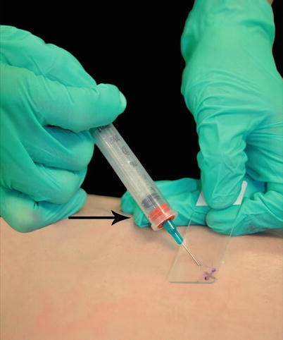 Injections | SpringerLink