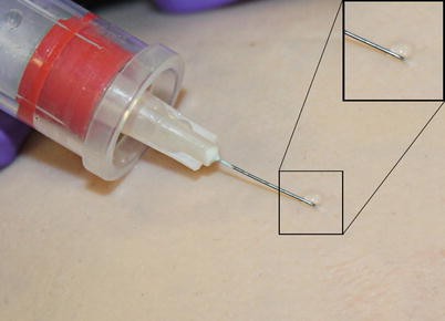 Injections | SpringerLink