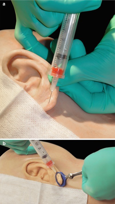 Injections | SpringerLink