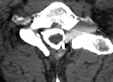 Dorsal Root Entry Zone (DREZ) Lesion | SpringerLink