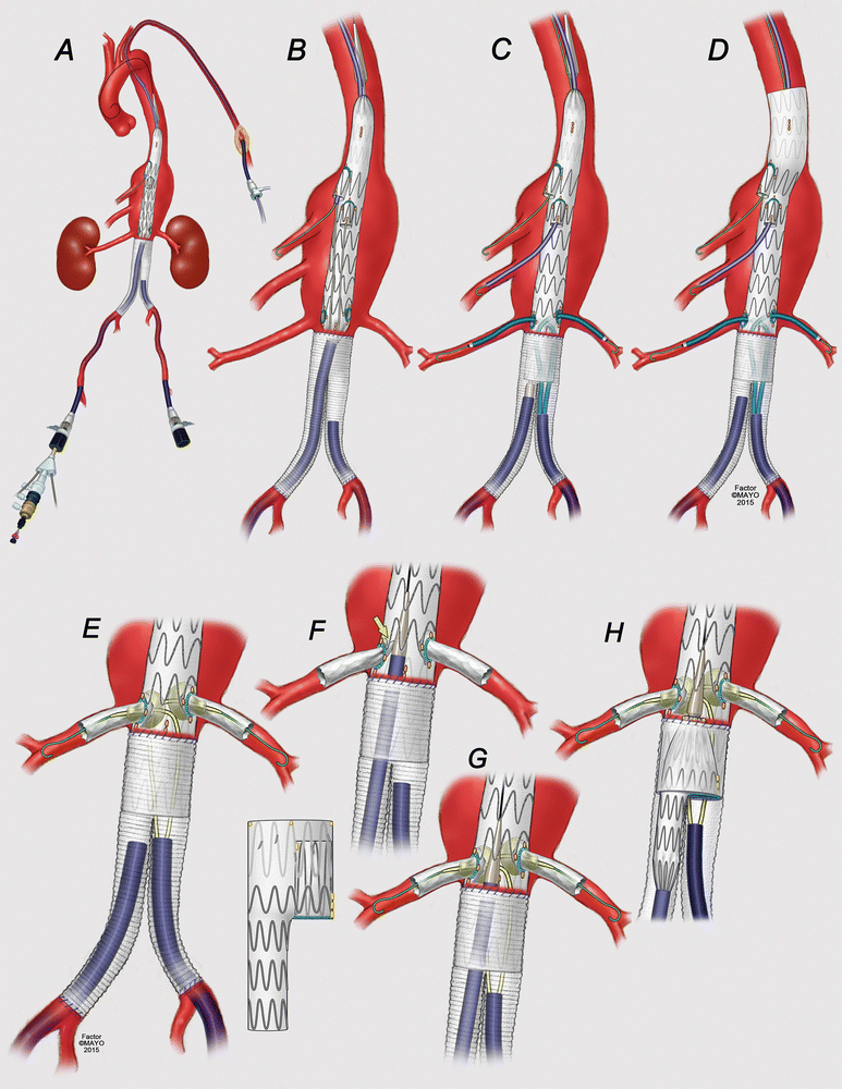 Techniques of Implantation of Fenestrated and Multibranched Stent ...