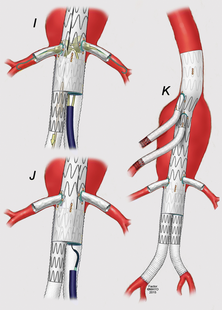 Techniques of Implantation of Fenestrated and Multibranched Stent ...