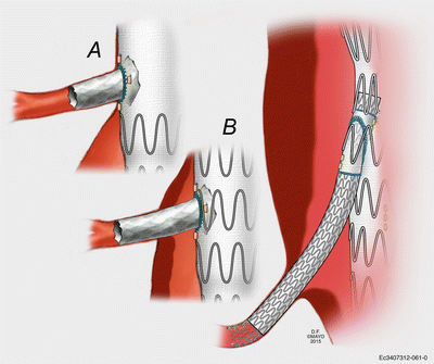 Techniques of Implantation of Fenestrated and Multibranched Stent ...