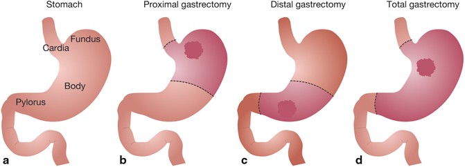 Methods of Reconstruction—BI, BII, Roux-en-Y, Jejunal Interposition, Proximal Gastrectomy and ...