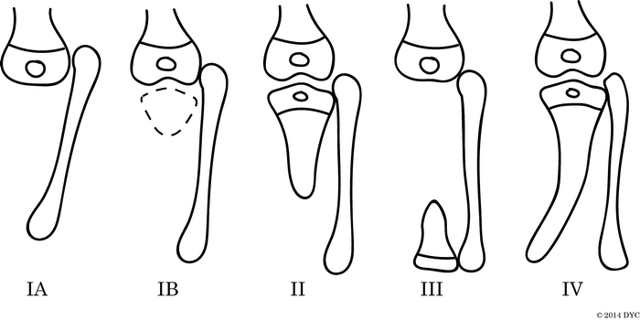 Tibial Hemimelia | SpringerLink