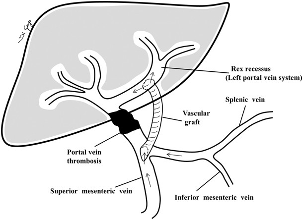 Portal Hypertension in Children | SpringerLink