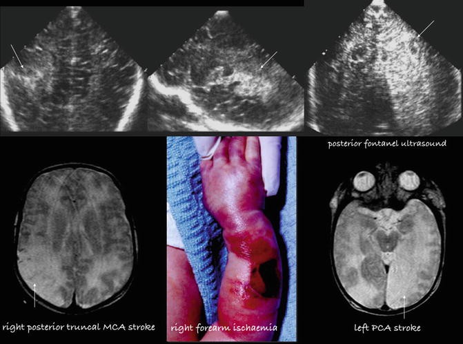 Neonatal Stroke: Clinical Presentation, Imaging, Treatment, and ...