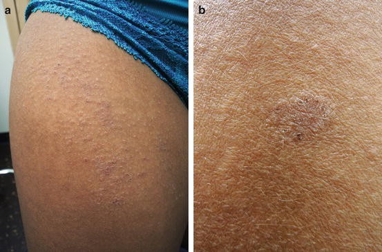 Nummular Eczema | SpringerLink