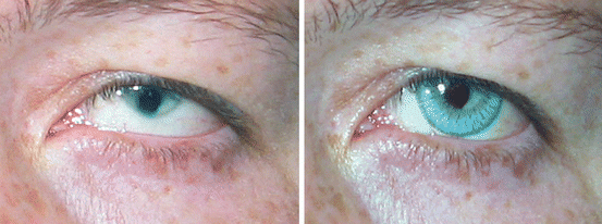 Scleral Shell Prostheses and Prosthetic Contact Lenses | SpringerLink