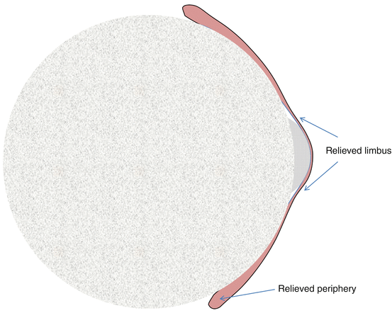 Scleral Shell Prostheses and Prosthetic Contact Lenses | SpringerLink