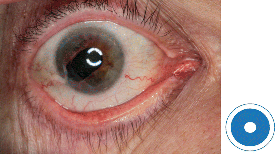 Scleral Shell Prostheses and Prosthetic Contact Lenses | SpringerLink