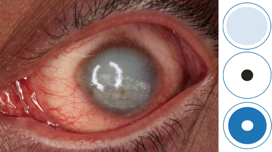 Scleral Shell Prostheses and Prosthetic Contact Lenses | SpringerLink