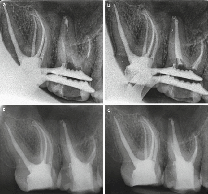 Root Canal Obturation | SpringerLink