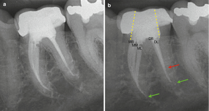Root Canal Obturation | SpringerLink