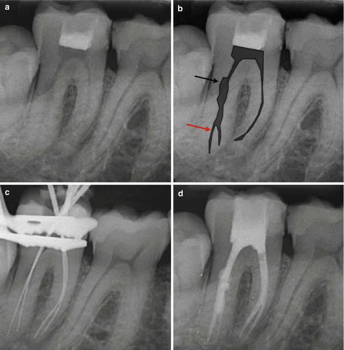 Root Canal Obturation | SpringerLink