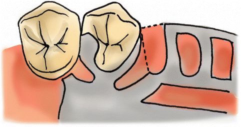 Direct and Indirect Retainers | SpringerLink