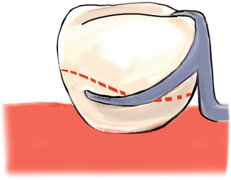 Direct and Indirect Retainers | SpringerLink