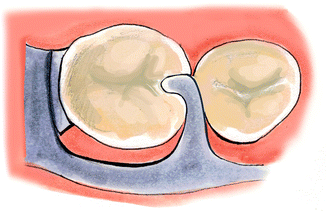 Direct and Indirect Retainers | SpringerLink