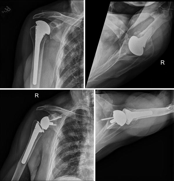 Conversion of Failed Hemiarthroplasty to Reverse Total Shoulder ...