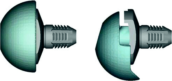 The SMR® Shoulder System of Lima Corporate | SpringerLink