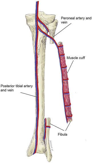 From Autologous Flaps to Engineered Vascularized Grafts for Bone ...