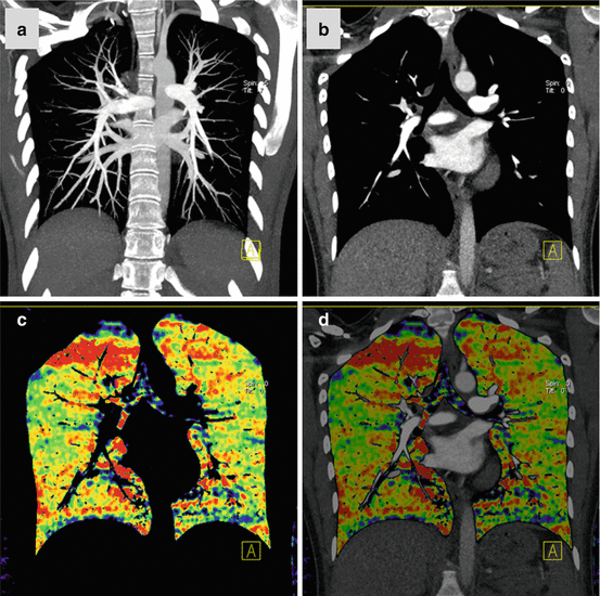 Dual-Energy CT in Thoracic Imaging | SpringerLink