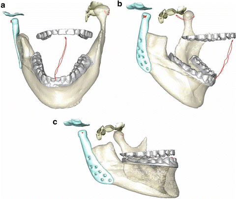 TMJ Biomechanics | SpringerLink