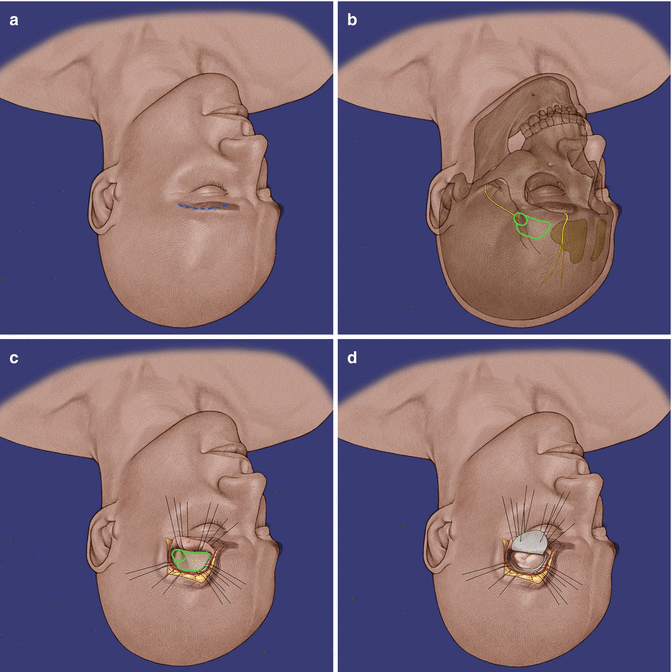 Supraorbital Approach | SpringerLink