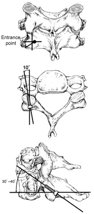 Lateral Mass Screw Fixation of the Subaxial Cervical Spine | SpringerLink