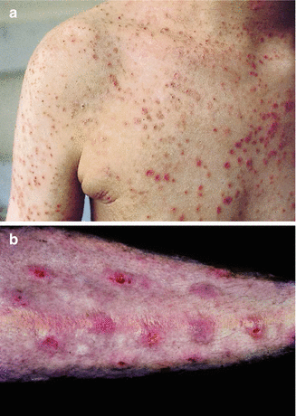 Clinical Symptoms of Atopic Eczema | SpringerLink