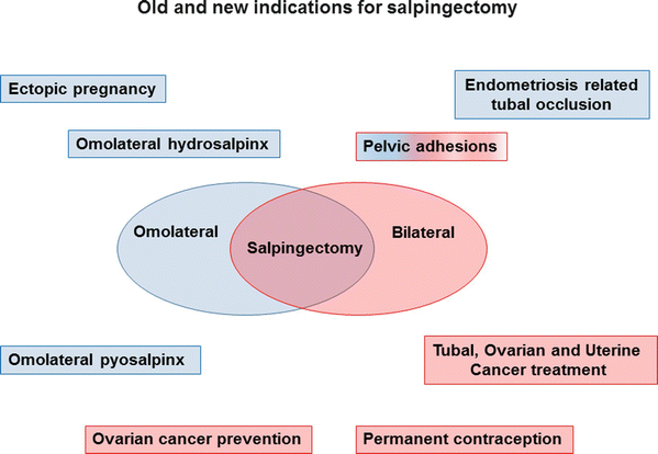 Indications for Salpingectomy | SpringerLink