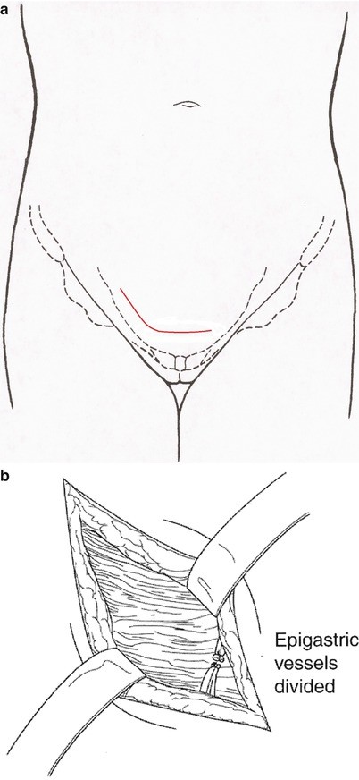 Transverse Incisions Springerlink
