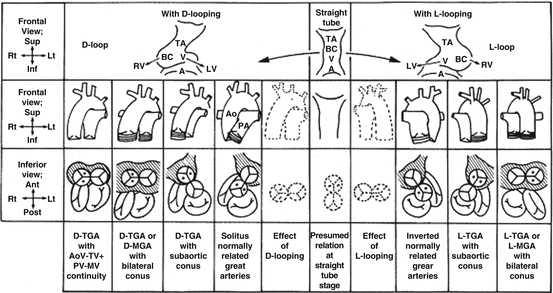 Definition of Conotruncal Anomalies | SpringerLink