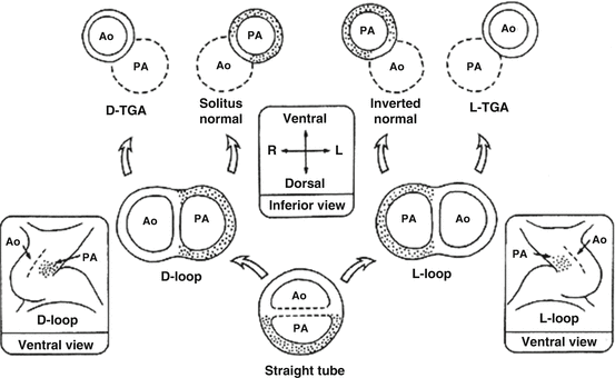 Definition of Conotruncal Anomalies | SpringerLink