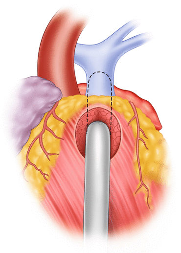 Tetralogy of Fallot: Transventricular Repair, Including Pulmonary ...