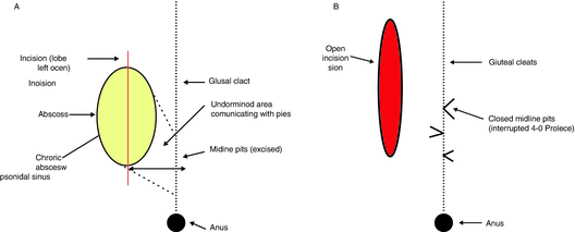 Pilonidal Disease | SpringerLink