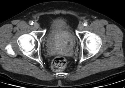 Imaging of Benign Prostatic Conditions | SpringerLink
