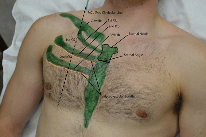 Needle Thoracostomy for decompression of Tension Pneumothorax ...