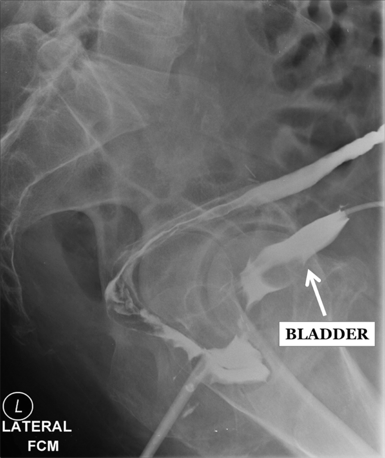 Complex Anorectal Fistulas | SpringerLink