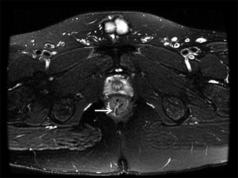 Complex Anorectal Fistulas | SpringerLink