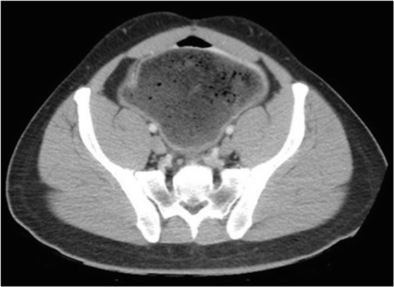 Complications of the Ileal Pouch | SpringerLink
