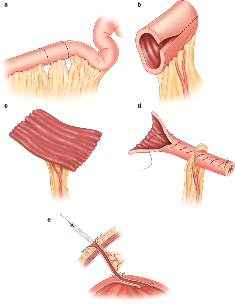 Intestinal Stomas | SpringerLink