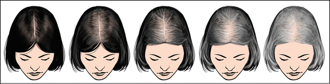 Classification and Scoring of Androgenetic Alopecia (Male and Female ...