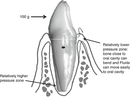 Orthodontitis: The Inflammation Behind Tooth Movement and Orthodontic ...